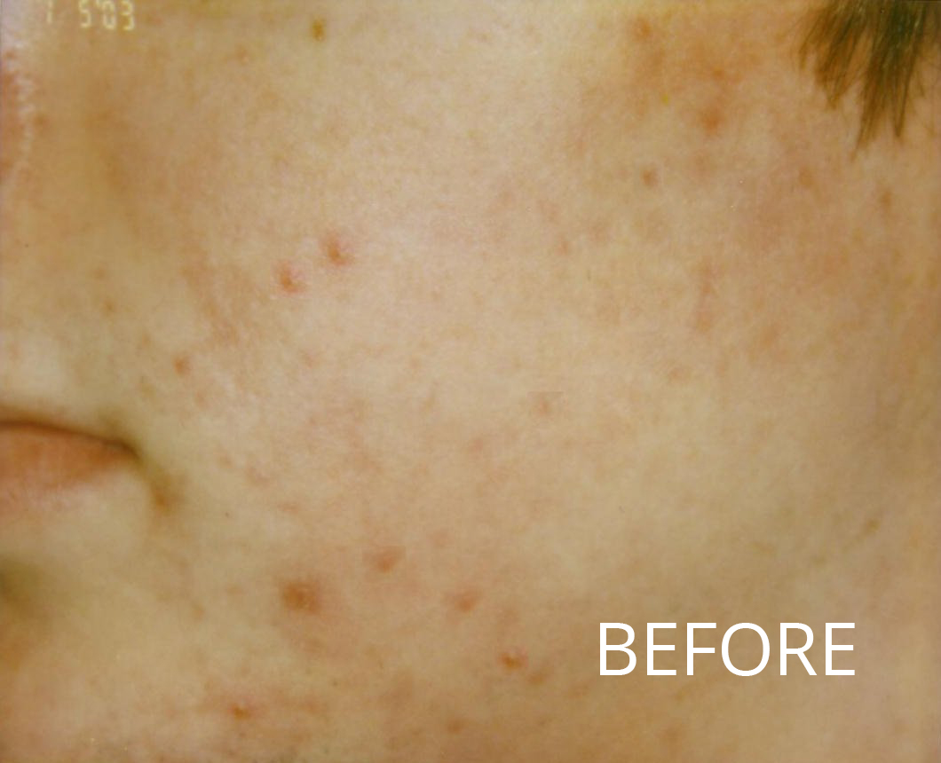 Acne Treatment in South Croydon